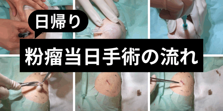 日帰りで行う粉瘤の当日手術を解説！患者様の負担は最小限で行います 北海道皮膚のできものと粉瘤クリニック古林形成外科 札幌院｜中央区大通にて