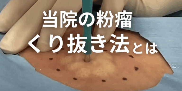 粉瘤手術の「くり抜き法」とは？手術手順を形成外科専門医が解説 北海道皮膚のできものと粉瘤クリニック古林形成外科 札幌院｜中央区大通にて皮膚