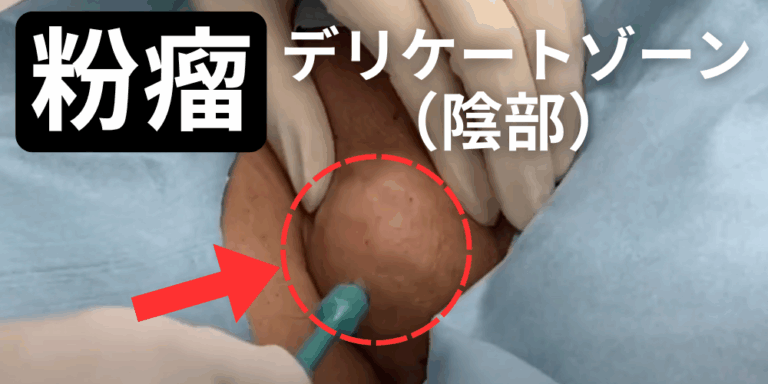 陰部（デリケートゾーン）に粉瘤ができる原因と特に女性に多い理由 北海道皮膚のできものと粉瘤クリニック古林形成外科 札幌院｜中央区大通にて