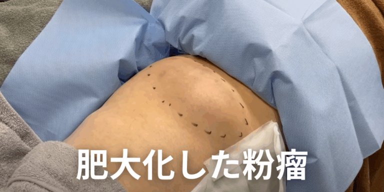 背中にできる痛い粉瘤（アテローム）の特徴と主な症状を解説 北海道皮膚のできものと粉瘤クリニック古林形成外科 札幌院｜中央区大通にて皮膚悩み