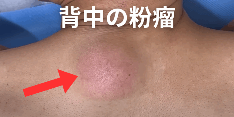背中にできる痛い粉瘤（アテローム）の特徴と主な症状を解説 北海道皮膚のできものと粉瘤クリニック古林形成外科 札幌院｜中央区大通にて皮膚悩み