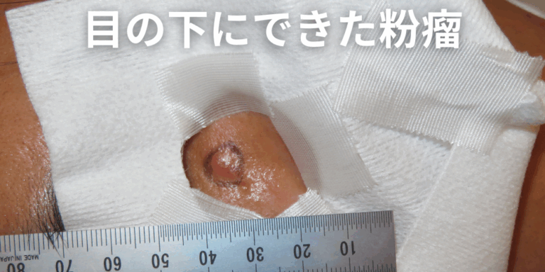 粉瘤手術の費用と実際にかかる金額 北海道皮膚のできものと粉瘤クリニック古林形成外科 札幌院｜中央区大通にて皮膚悩みを土日祝も対応【皮膚科