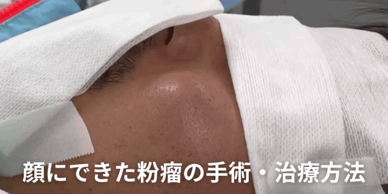 目のまわりにできる粉瘤（ふんりゅう）とは？部位別の特徴・原因・治療法まで専門医が徹底解説 北海道皮膚のできものと粉瘤クリニック古林形成外科